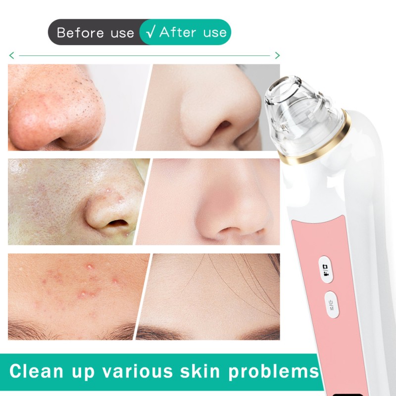 Blackhead Remover Extraction Tool With HD Camera For Visual Blackhead ...