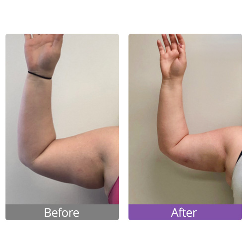 How about ultrasonic cavitation at home before and after？