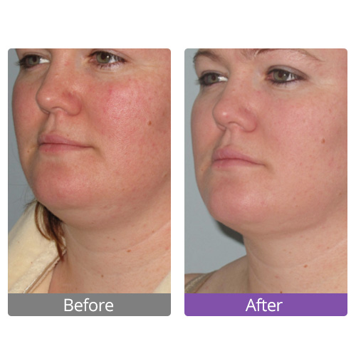 How about ultrasonic cavitation at home before and after？