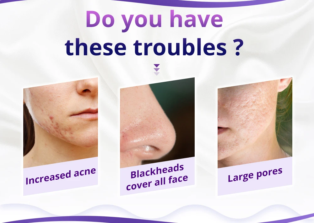 Best Microdermabrasion Machine at Home for Acne Scars