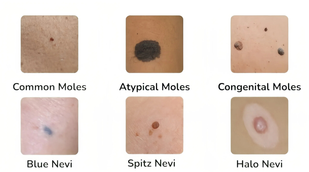 How to Remove Moles From Face Naturally: Safe Methods & Tips