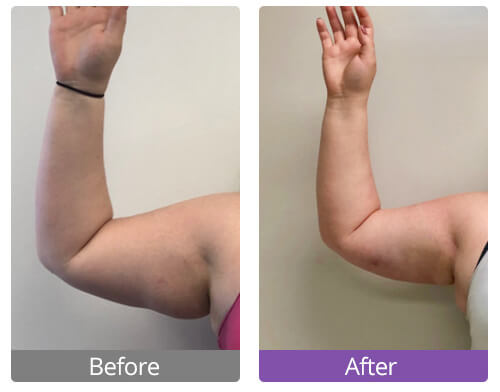 Ultrasonic Cavitation Before and After (With Photos)