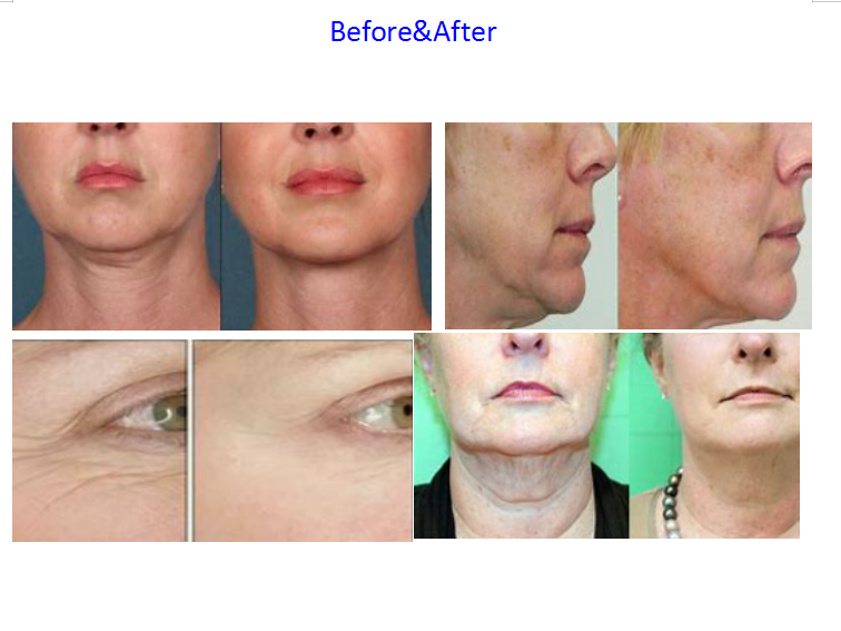 3D Smart Radio Frequency Skin Tighten Lifting And Rejuvenation