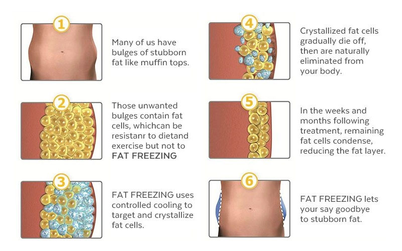 Cryolipolysis Fat Removal Treatment